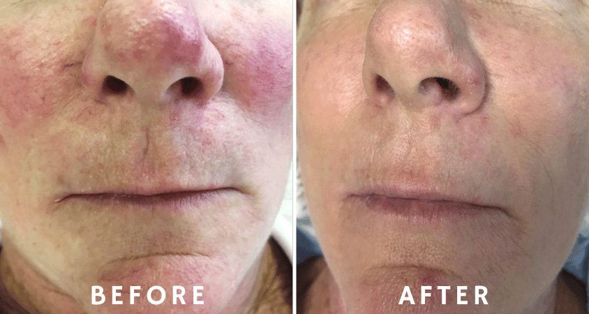 Viora IPL - Rejuvena Clinic