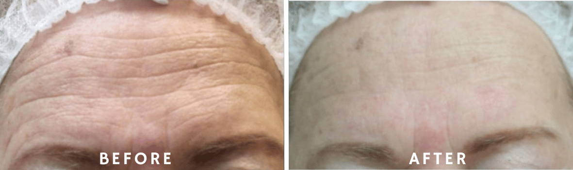 Viora IPL - Rejuvena Clinic