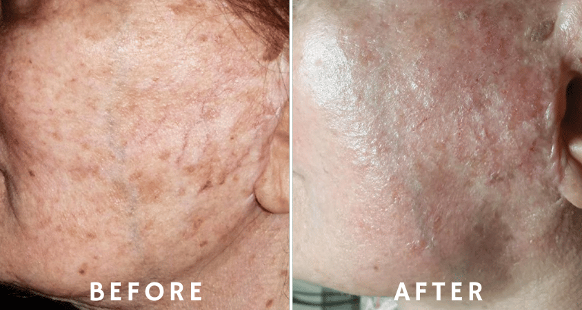 Viora IPL - Rejuvena Clinic